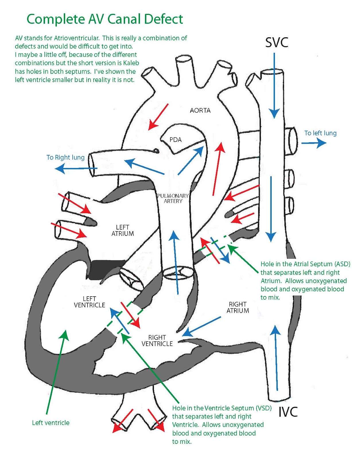 Kaleb Prinz: KALEB'S HEART CONDITION