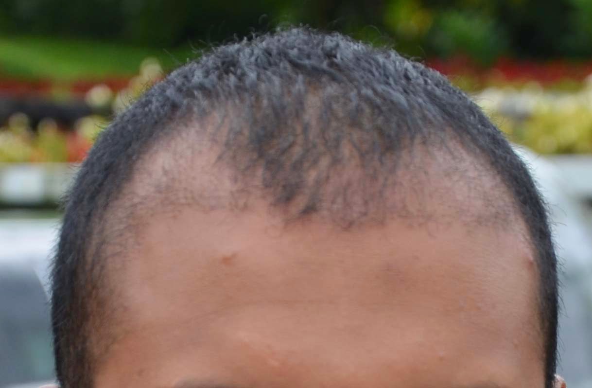 hair transplant experience - pengalaman transplantasi rambut / tanam ...