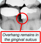ContacEZ - Ultimate Interproximal Solution: New Product Video: Copper ...