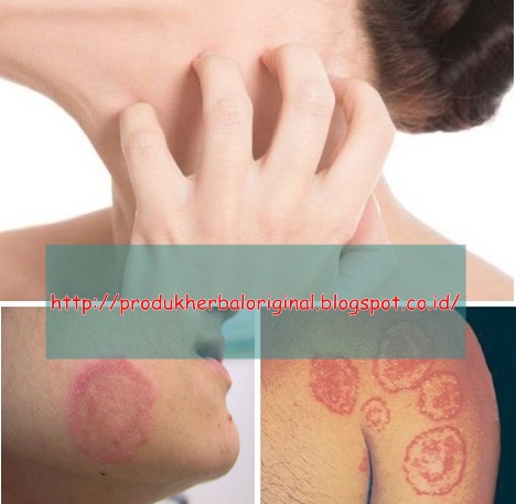 Cara Mengatasi Kurap Pada Kulit Tubuh Secara Efektif Dan Cepat (Obat ...