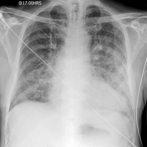 Balkan Hajmo Sloboda: Zašto se stvara voda u plućima i kako se leči na ...