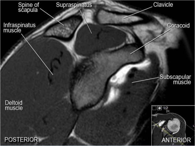 MRI Musculo-Skeletal Section: MRI anatomy of the shoulder (sagittal view).