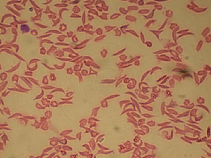 Notes from the Ninth Circle: Sickle Cell Anemia