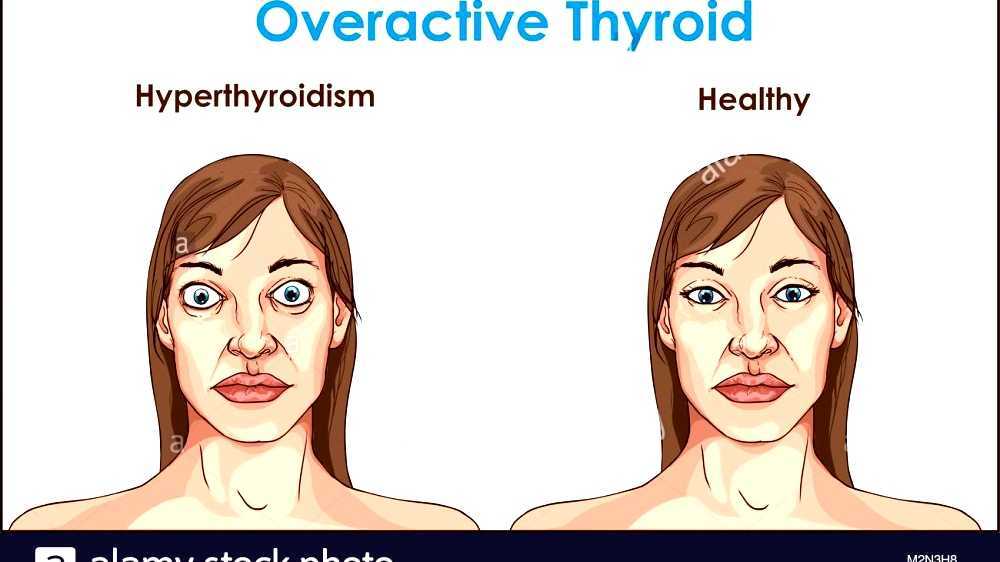 Hyperthyroidism