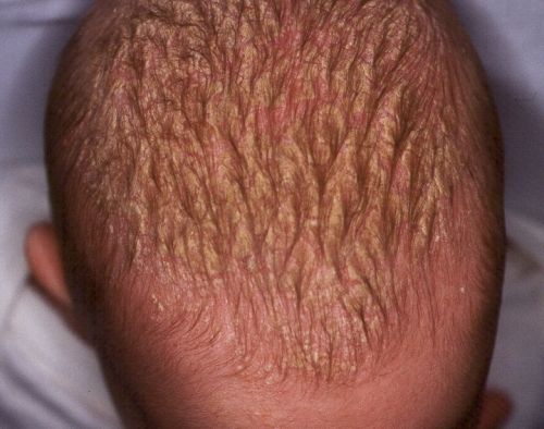Dermatitis seborreica