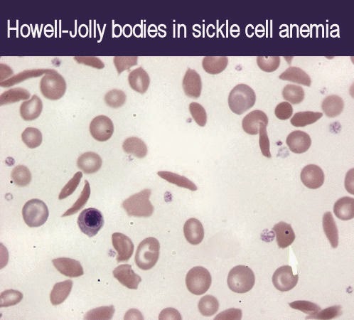 Medical Laboratory and Biomedical Science: Howell-Jolly bodies in ...