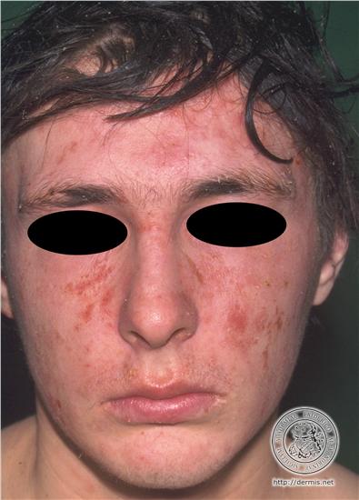 DERMATITIS SEBORREICA