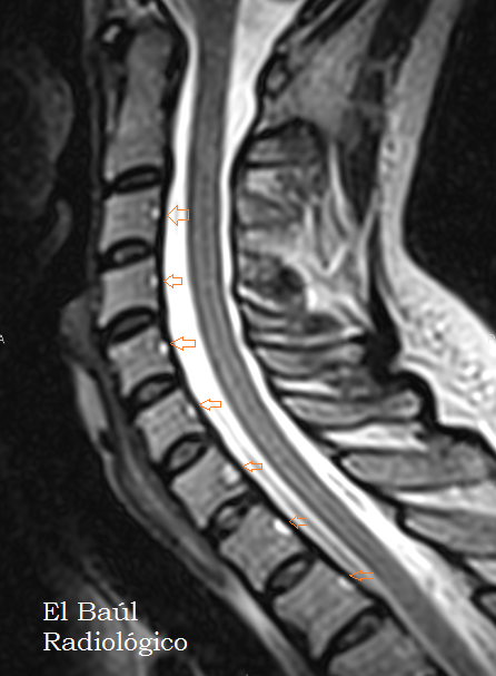 El Baúl Radiológico: VENAS BASIVERTEBRALES. (Basivertebral Veins: CT ...
