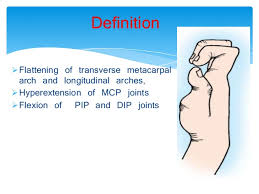 Claw Hand, or 'Spinster's Claw #medical article #anatomy - LANKA STUDENTS