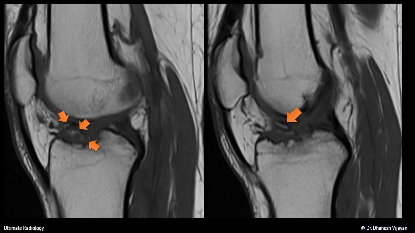 Ultimate Radiology : ACL avulsion fracture