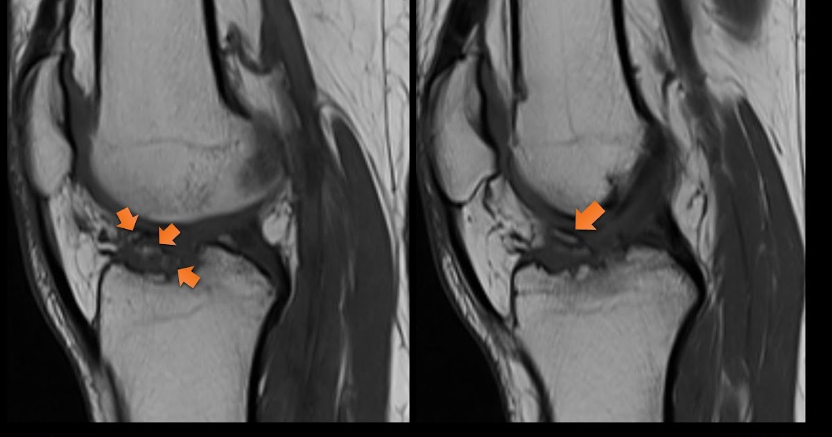 Ultimate Radiology : ACL avulsion fracture