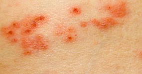 Are shingles contagious to kids, babies and newborns (infant) - Health ...
