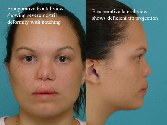 Dr. Dean Toriumi Reviews: Dean Toriumi: Cleft Lip and Reconstructive ...