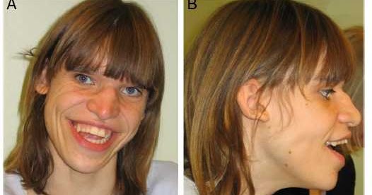 pediatric neurology: Dysmorphology in identifying syndromic causes of ...