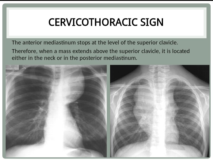 Chest Medicine Made Easy-Dr Deepu: Cervico thoracic sign