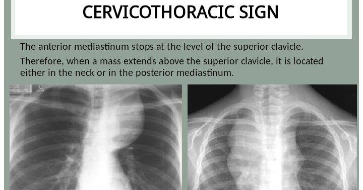 Chest Medicine Made Easy-Dr Deepu: Cervico thoracic sign