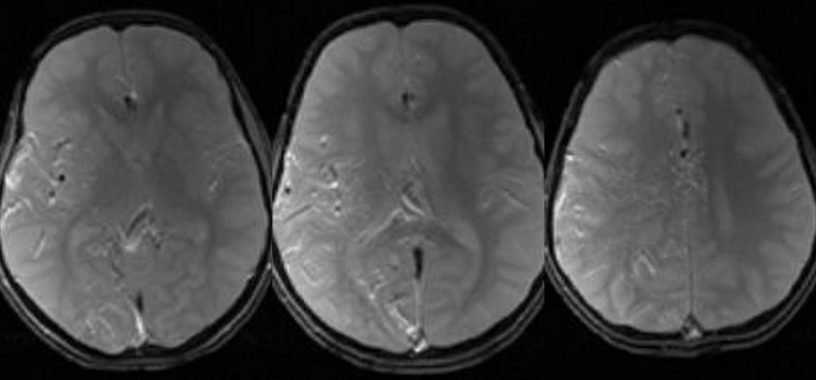 Dr Balaji Anvekar FRCR: Arterio Venous Malformation (AVM)