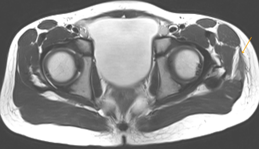 mricases: Iliotibial Band syndrome - Hip