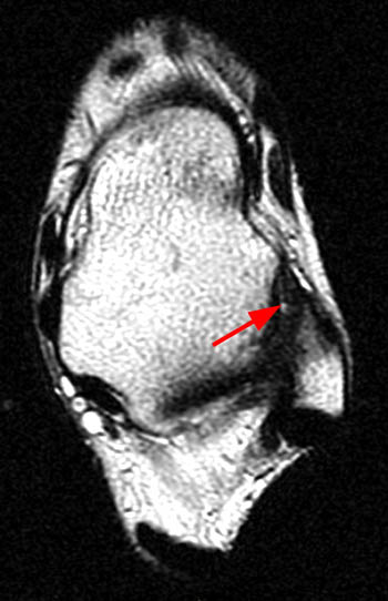 MRI Musculo-Skeletal Section: Accessory anterior inferior tibio-fibular ...