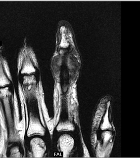 GCT of Tendon Sheath-MRI - Sumer's Radiology Blog