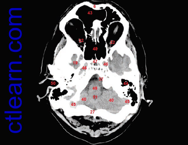 Anatomy CT Axial Brain