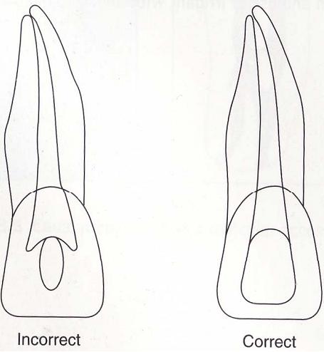 Dentistry lectures for MFDS/MJDF/NBDE/ORE: Principles of Access Cavity ...