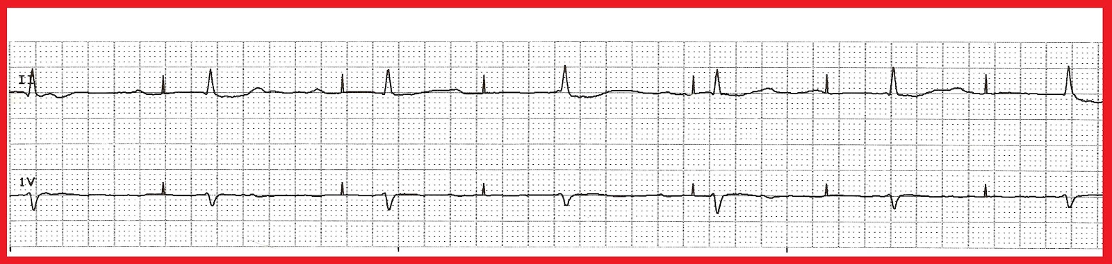 Practice EKG Strips