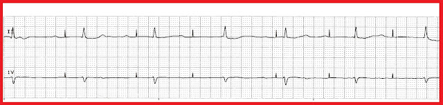 Practice EKG Strips