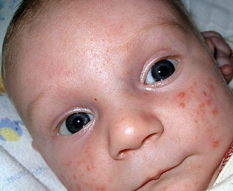 Baby Pimples | Infant and Babies Acne: Baby Pimples on face