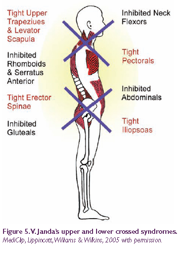 Very Effective Fitness Training: Upper & Lower Crossed Syndrome