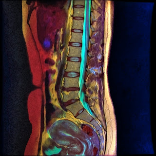 Nevit's blog: Color MRI of the Lumbar spine with extruded disc