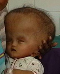 sikkahoder: MENGENAL HIDROSEPHALUS DAN PEMBAGIANNYA