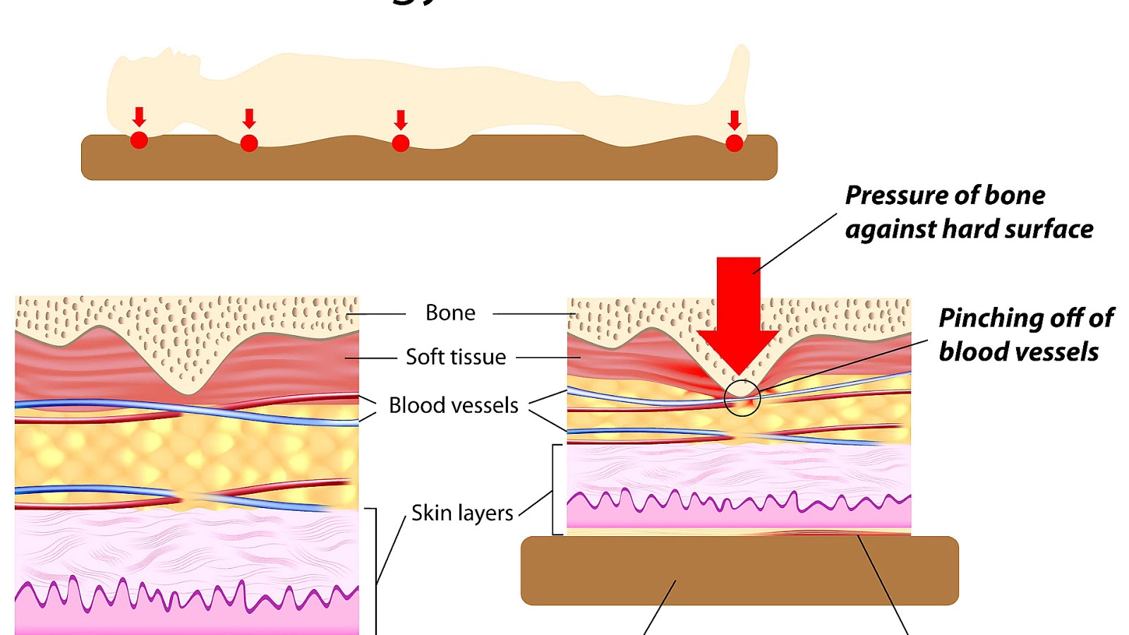 Pressure Ulcer Bed - Ulcer Choices