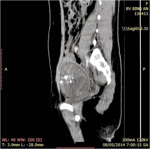 VIETNAMESE MEDIC ULTRASOUND: CASE 253: GOSSYPIBOMA (TEXTILOMA) POST ...