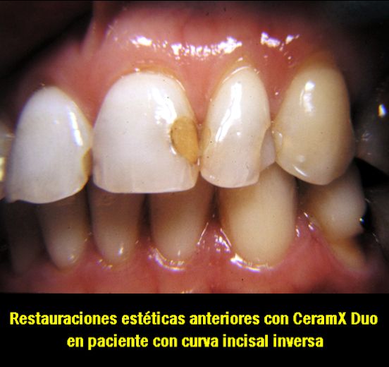 OPERATORIA DENTAL: Restauraciones estéticas anteriores con CeramX Duo ...