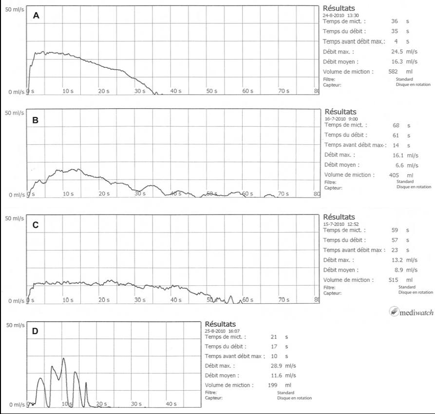 Les incontinences urinaires de l’homme (La débitmétrie urinaire et.....)