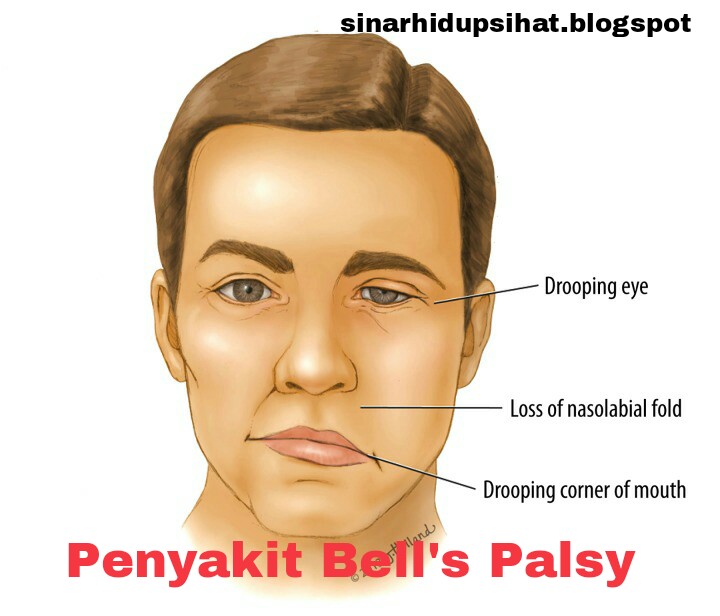 Penyakit Bell's Palsy merupakan penyakit Saraf Yang menyerang Wajah ...