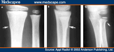 Vickie - My Journey: Buckle Fracture