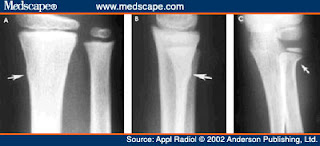 Vickie - My Journey: Buckle Fracture