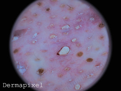 Dermapixel: febrero 2013