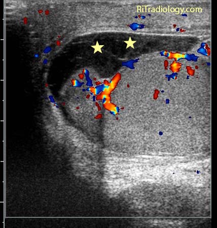 RiT radiology: Scrotal Pyocele