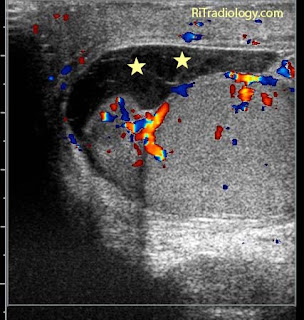RiT radiology: Scrotal Pyocele