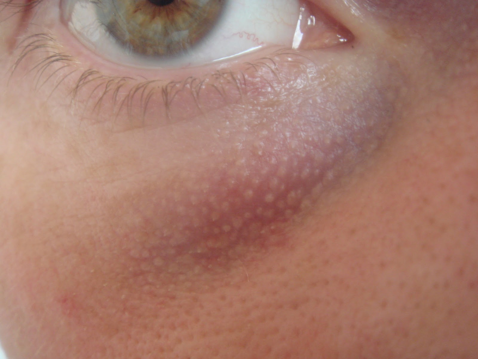 Jangan Ambil Mudah Dengan Kewujudan Bintik Putih Di Bawah Mata. Ia ...