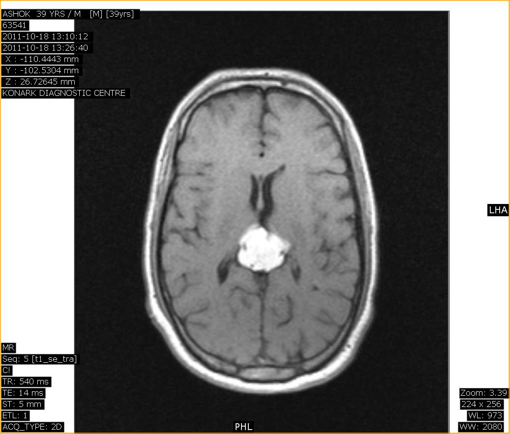 drvcsradiodiagnosis: corpus callosal lipoma- case report