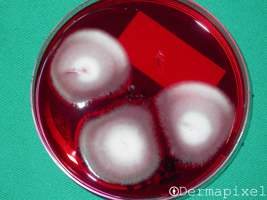 Dermapixel: Cuando los hongos atacan las uñas