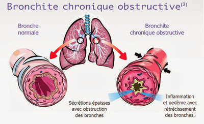 Blog 75: Infos santé-BPCO BronchoPneumopathie Chronique Obstructive