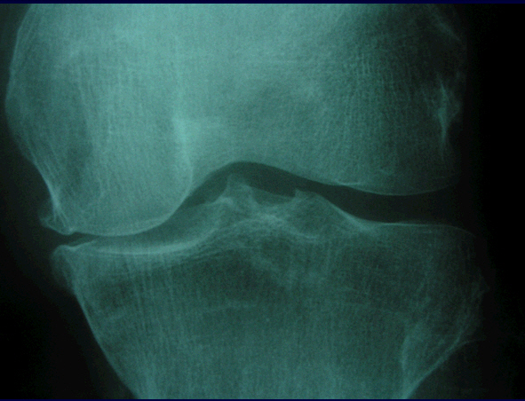 Rheumatologe: Arthrose / Definition, Diagnose und Dilemma