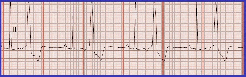 EKG Rhythm Strip Quiz 190