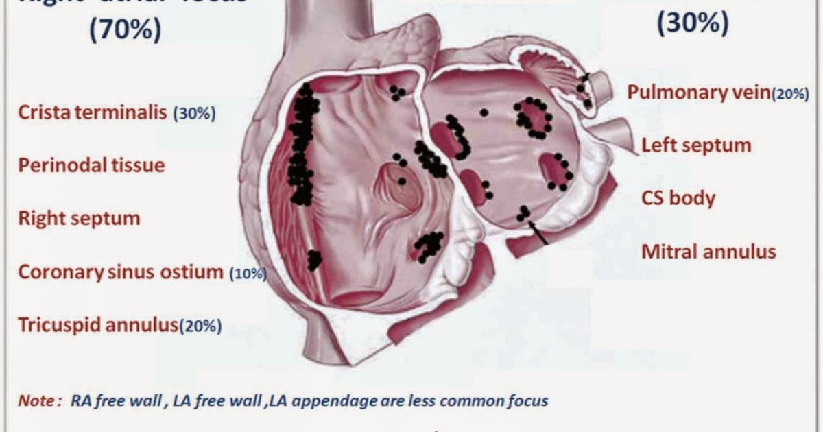 Ectopic Atrial Rhythm | INA - ECG