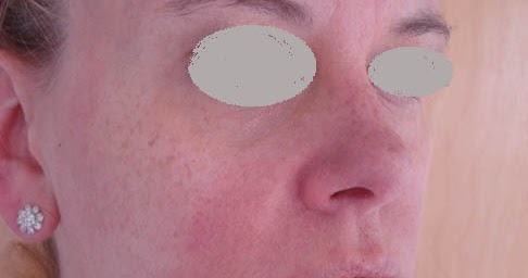 VIRTUAL GRAND ROUNDS IN DERMATOLOGY 2.0: 44 yo woman with facial erythema